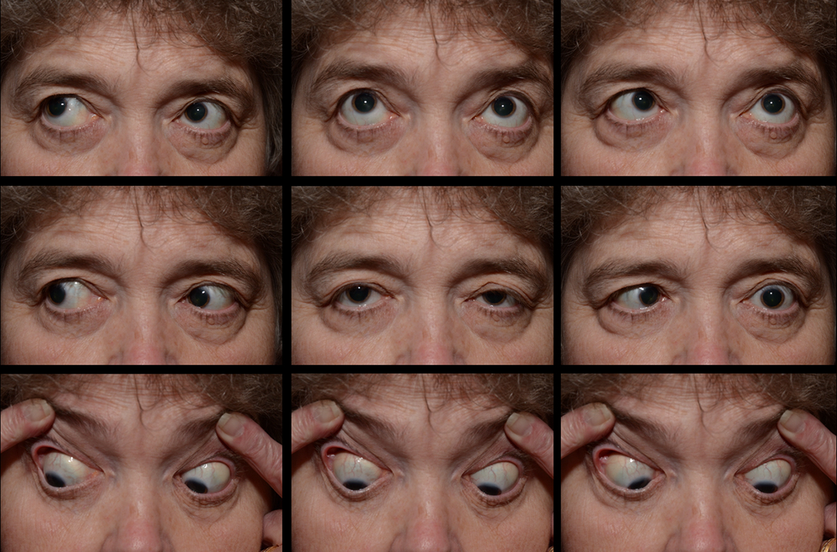 Cranial Nerve 6 Abducens Nerve Palsy Secondary To Schwannoma