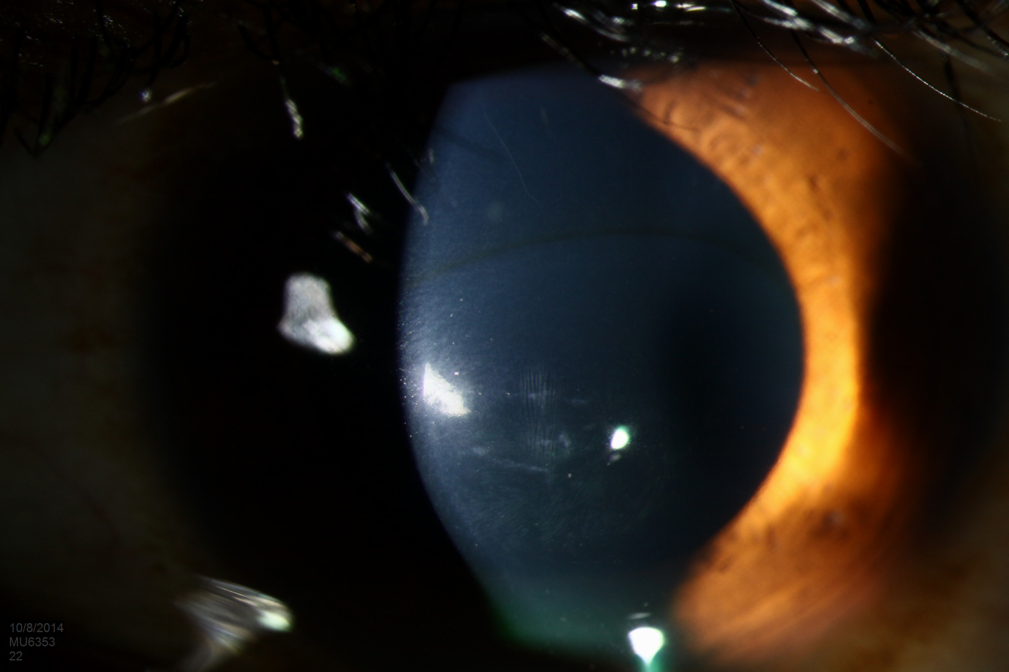 Keratoconus