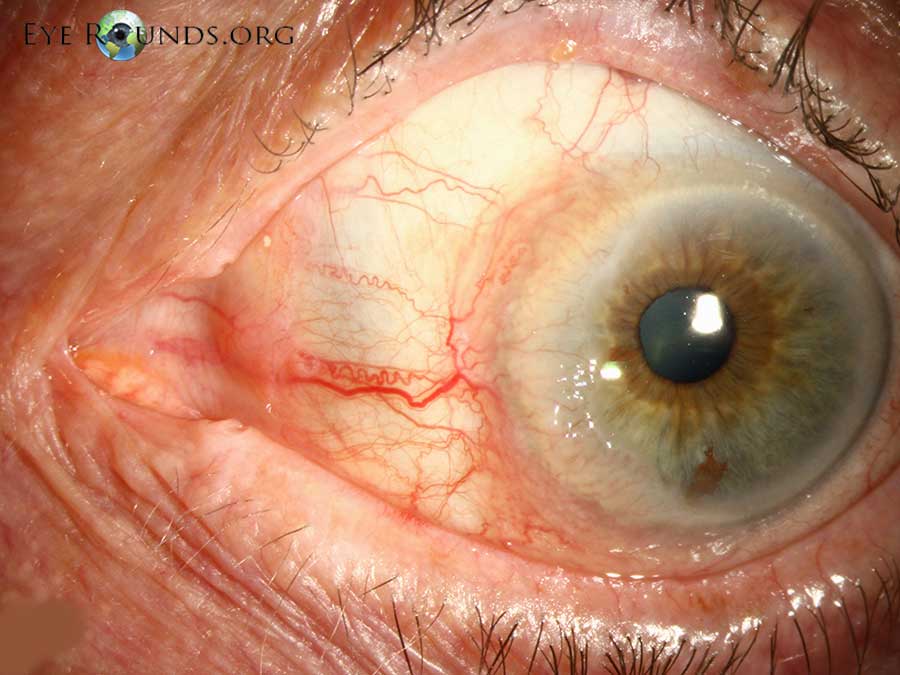 Atlas Entry Conjunctival Corneal Invasive Squamous Cell Carcinoma