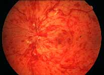 Central Retinal Vein Occlusion