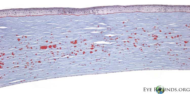 Atlas Entry - Granular dystrophy