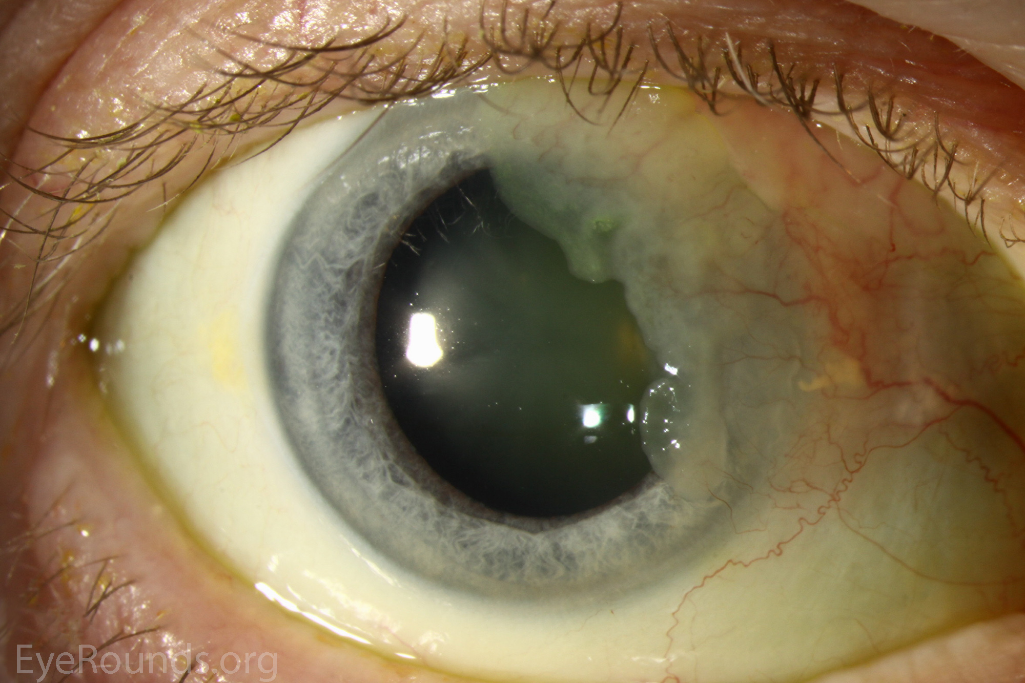 Atlas Entry - Ocular Surface Squamous Cell Carcinoma