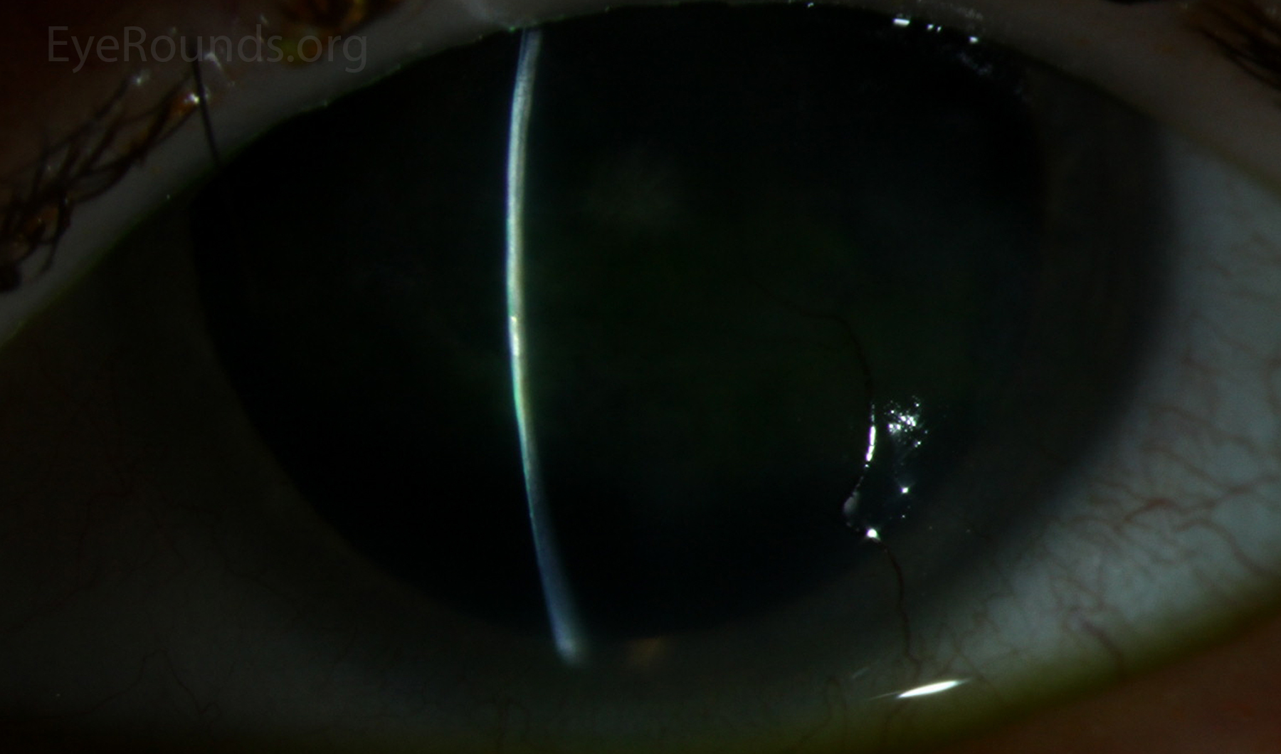 Atlas Entry - Riley-Day Syndrome (Familial Dysautonomia) with ...