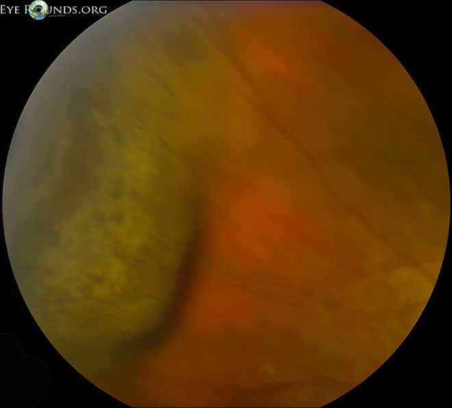 Choroidal Detachment: Hemorrhagic, Non-Appositional