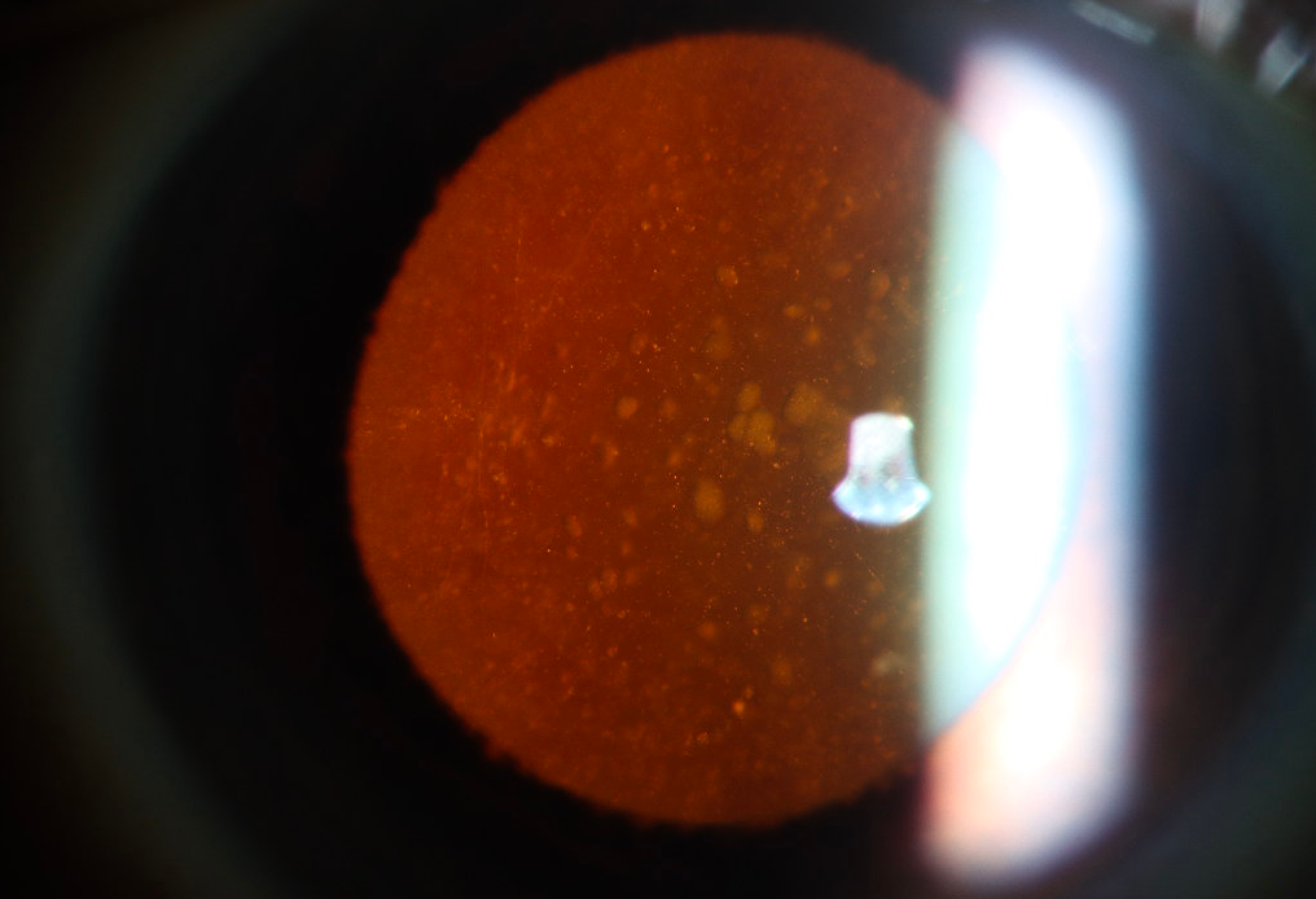 Cataract with cortical vacuoles