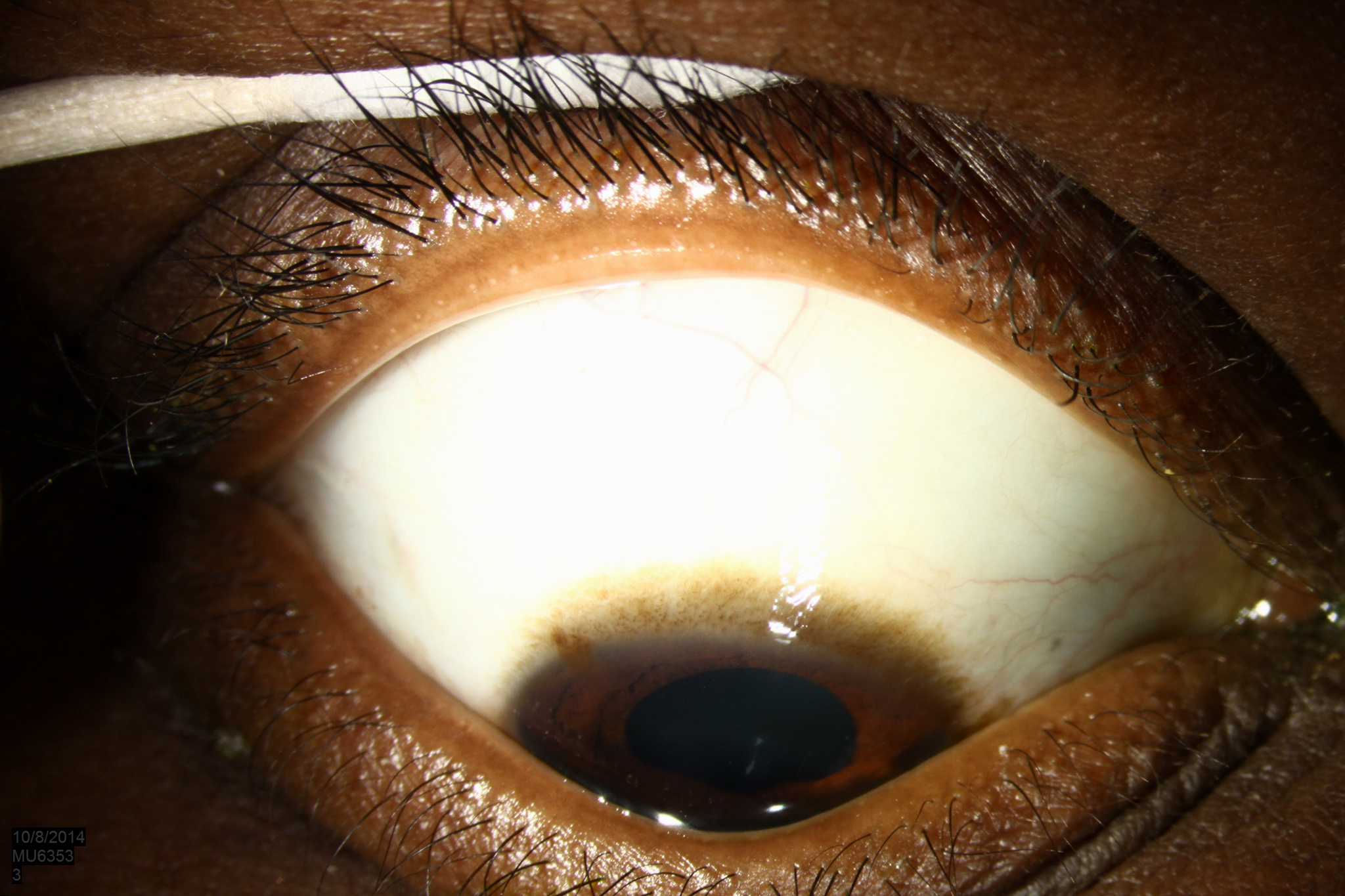 Keratoconus
