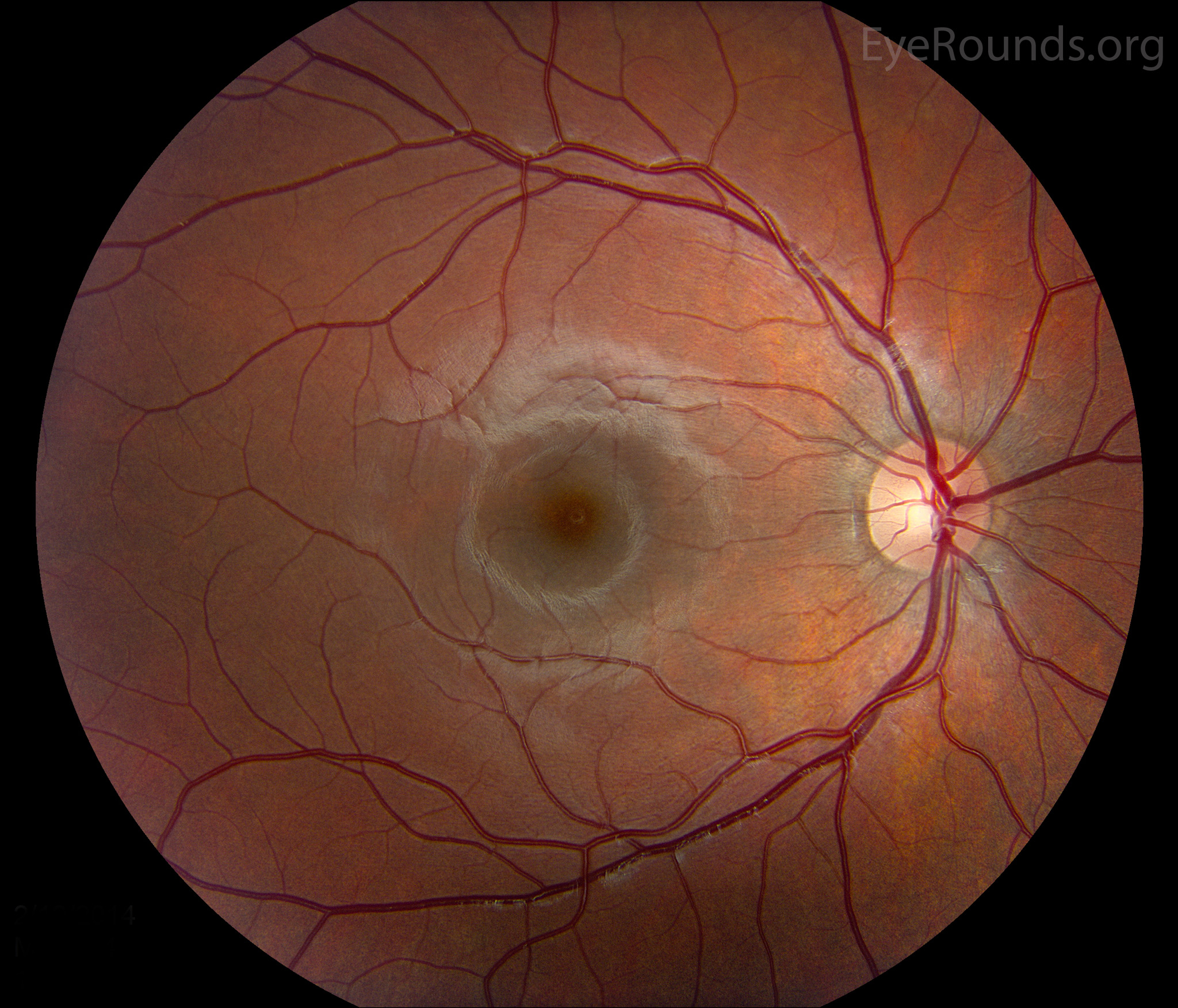 Atlas Entry - Normal fundus (child)