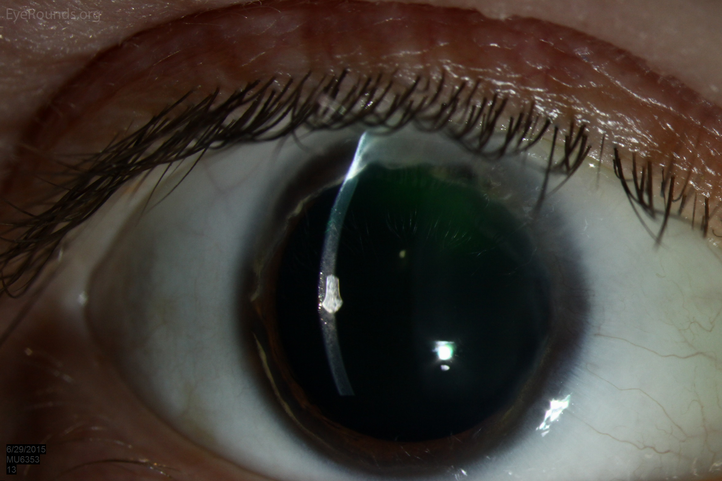 Terrien Marginal Degeneration : The University of Iowa, Ophthalmology