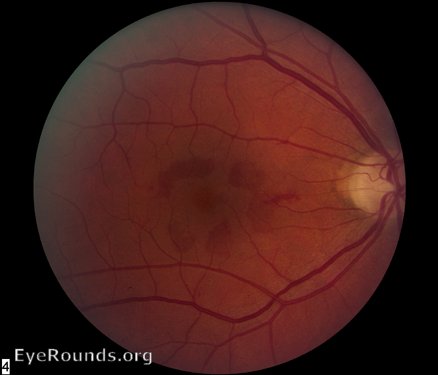 Acute Macular Neuroretinopathy (AMN)
