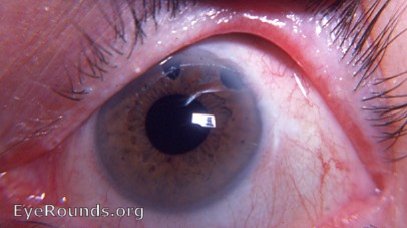 Perfect intracapsular cataract operation with two peripheral ...
