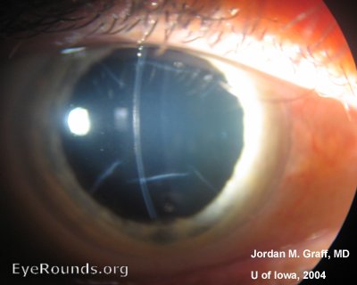 AK (astigmatic keratotomy). EyeRounds.org: Online Ophthalmic Atlas