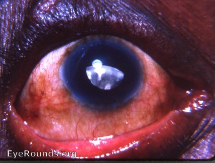 Subluxation of lens (A poor couching result). EyeRounds.org: Online ...