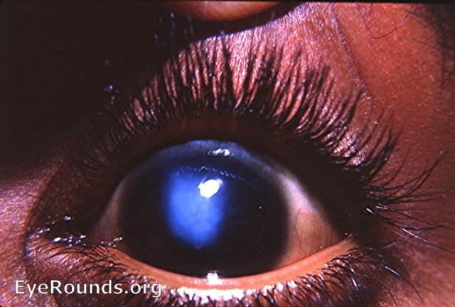 Primary congenital glaucoma (hydropthalmos) with central corneal ...