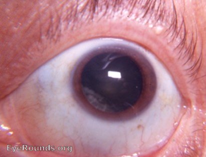 mature cataract. EyeRounds.org: Online Ophthalmic Atlas