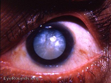 Intumescent cataract. EyeRounds.org: Online Ophthalmic Atlas