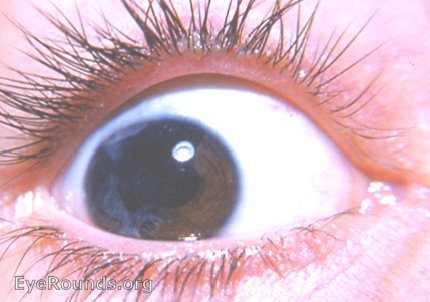 Iris atrophy following traumatic hyphema. EyeRounds.org: Online ...