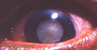 mature cataract. EyeRounds.org: Online Ophthalmic Atlas