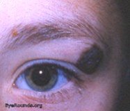 Pigmented nevus - left upper lid near outer canthus. EyeRounds.org ...