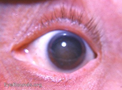 A discussion of the nuclear cataract. EyeRounds.org: Online Ophthalmic ...