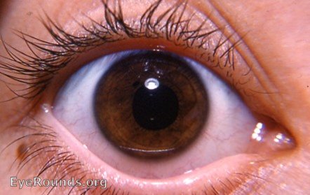 Pigmented nevus of right lower lid. EyeRounds.org: Online Ophthalmic Atlas