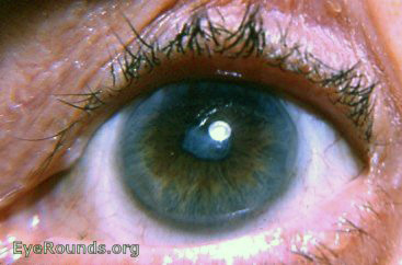 Post-endophthalmitis membrane with anterior uveitis, seclusio pupillae ...