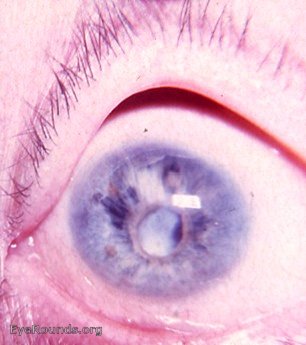 Intraocular lens (IOL) implant history. EyeRounds.org: Online ...