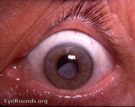 Spontaneously subluxated cataract with a history of recurrent anterior ...