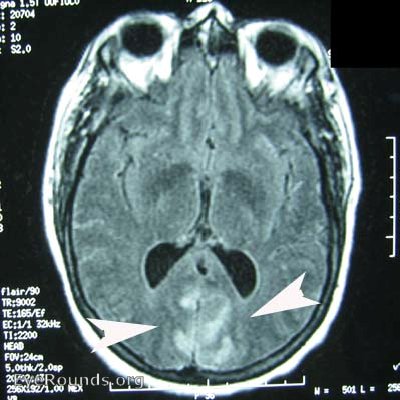 bilateral occipital infarcts (stroke). EyeRounds.org: Online Ophthalmic ...