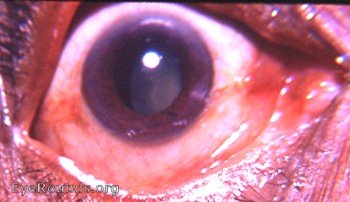 Subluxation of lens (A poor couching result). EyeRounds.org: Online ...