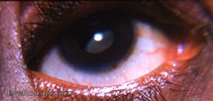 Subluxation of lens (A poor couching result). EyeRounds.org: Online ...
