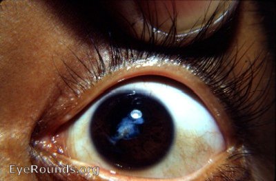 Traumatic aftercataract following a perforating injury of cornea ...