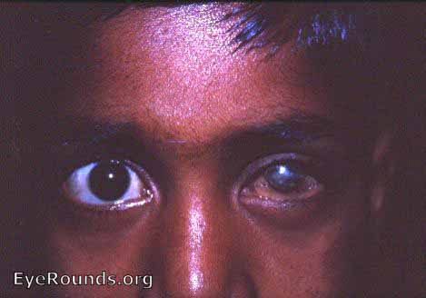 Vitamin A deficiency with xerophthalmia and spastic entropion with ...