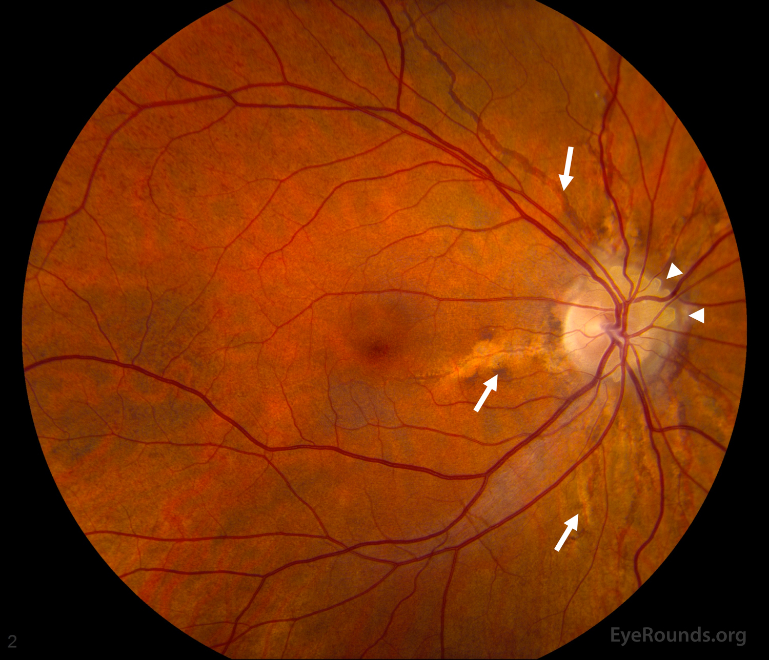 Angioid Streaks and Optic Disc Drusen in Pseudoxanthoma Elasticum : The ...