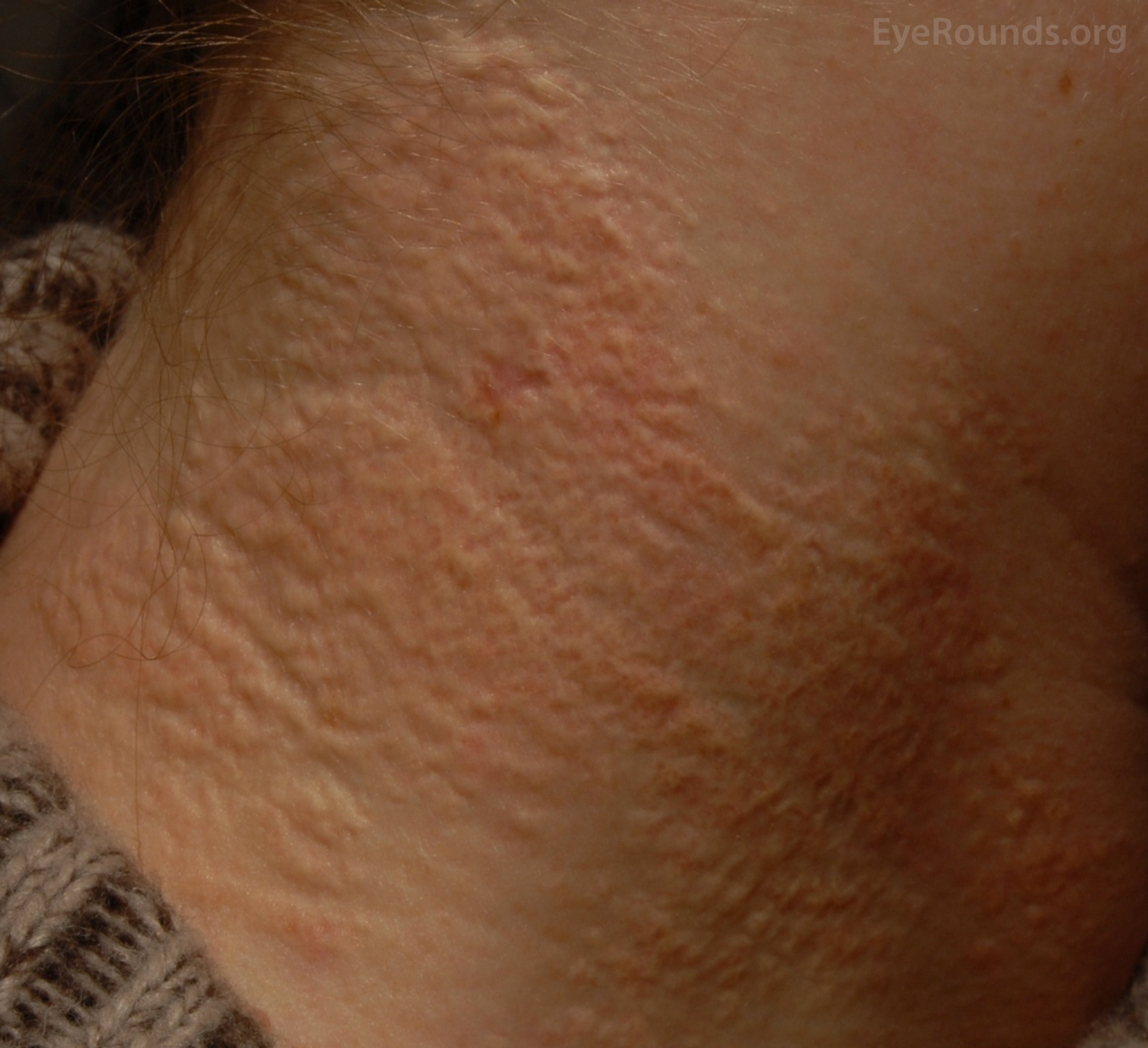 Angioid Streaks and Optic Disc Drusen in Pseudoxanthoma Elasticum : The ...