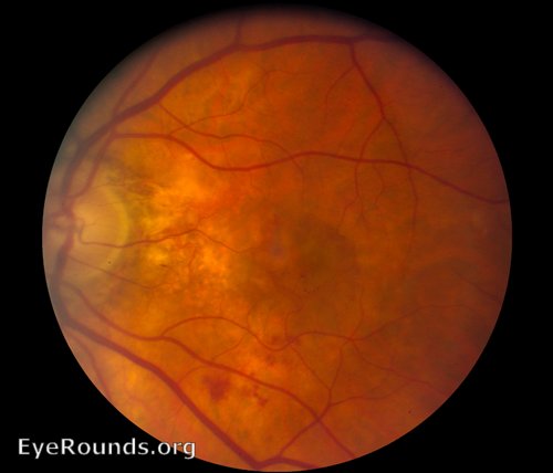 Atlas Entry - Age-related Macular Degeneration with Choroidal ...