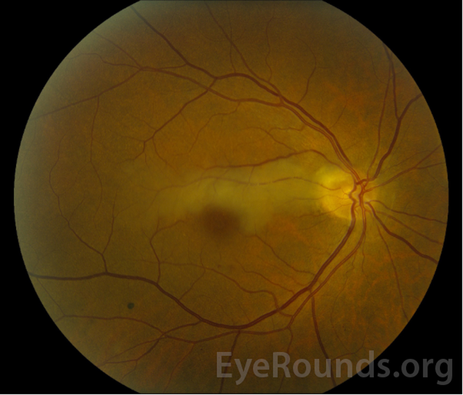 Atlas Entry - Cilioretinal Artery Occlusion