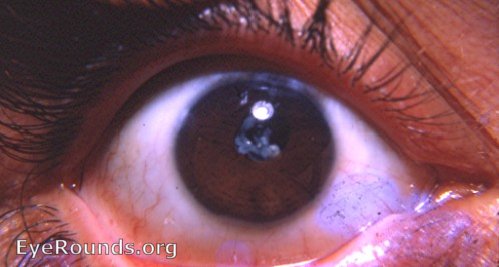 Post-needling Elschnig's pearls. EyeRounds.org: Online Ophthalmic Atlas
