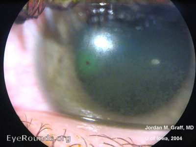 Atlas Entry - Ferrous foreign body: Rust ring