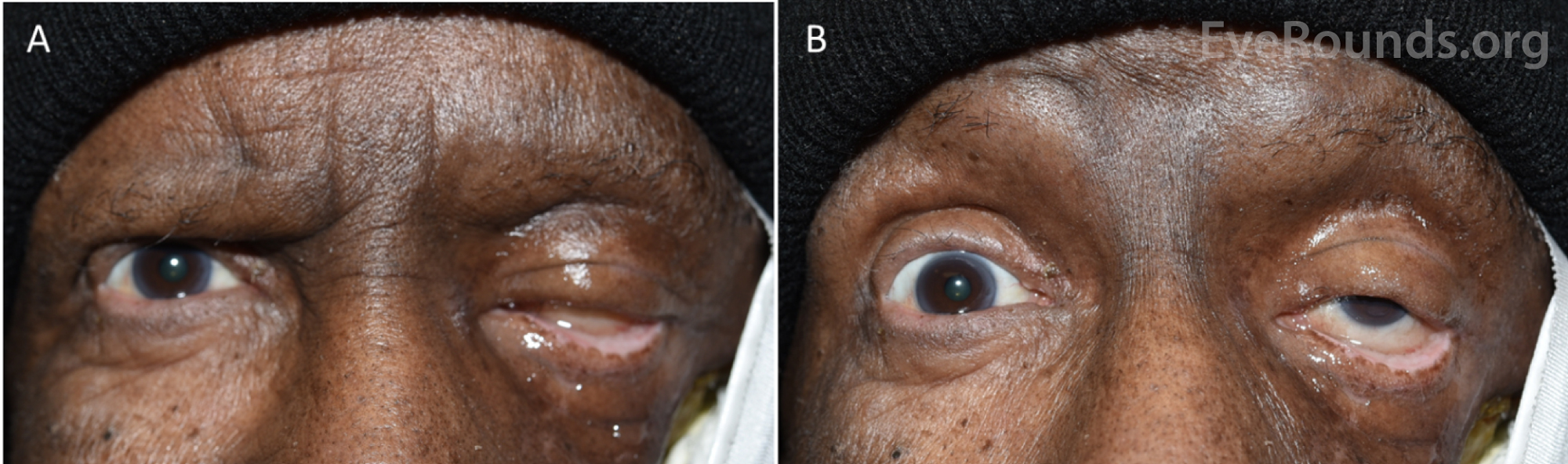 Neurotoxin Tarsorrhaphy