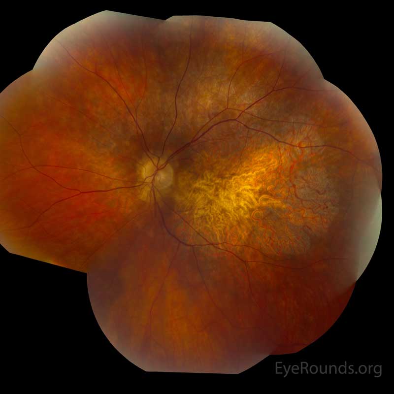 Pattern Dystrophy 3291