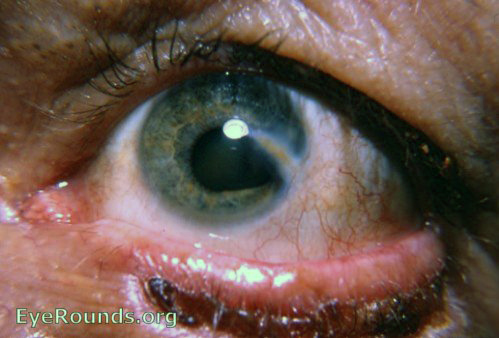Repaired perforating corneal injury with iridectomy. EyeRounds.org ...