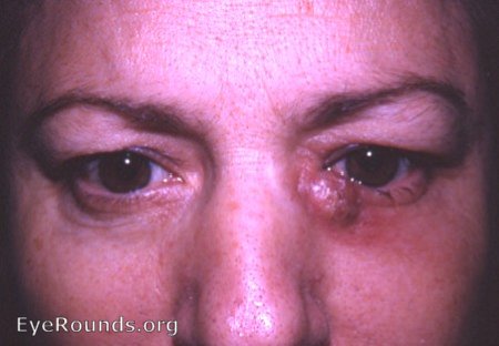 Chronic dacryocystitis