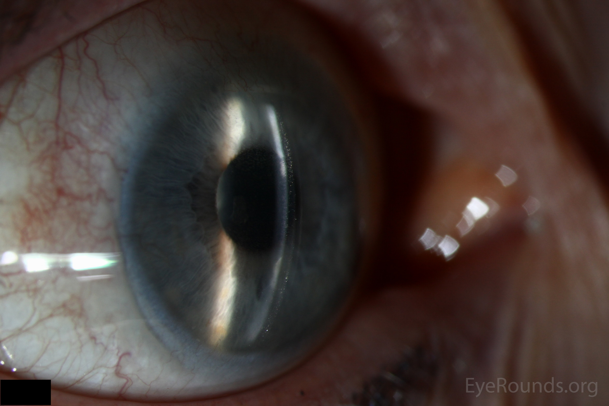 Atlas Entry - Appropriate Scleral Lens Sagittal Depth