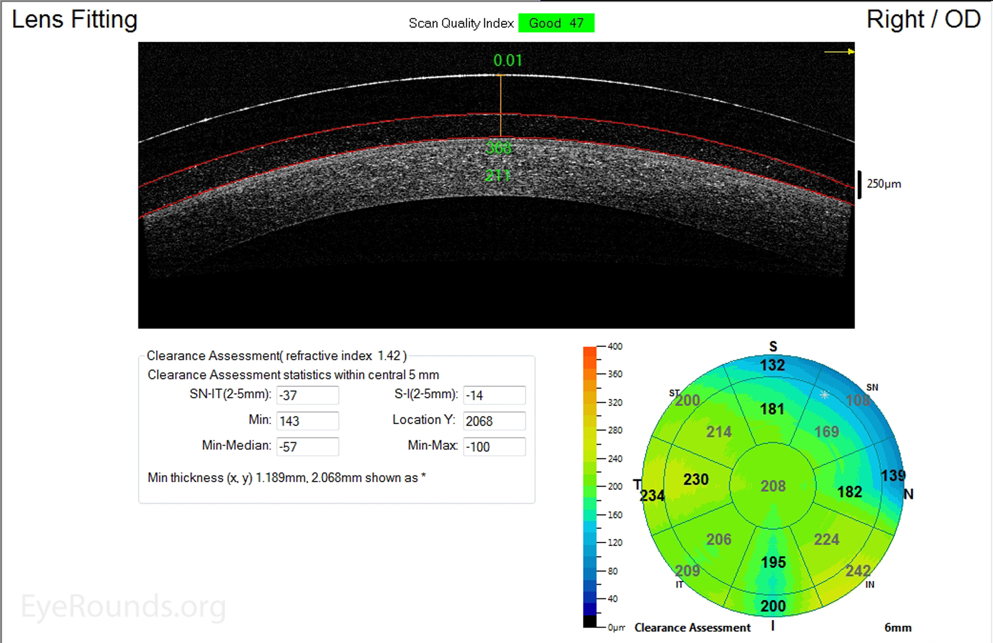 Atlas Entry - Appropriate Scleral Lens Sagittal Depth