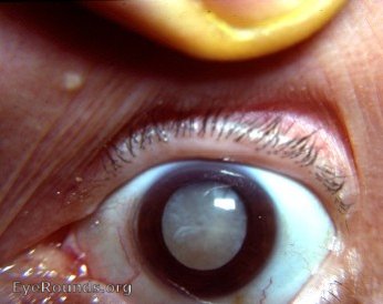 Intumescent cataract. EyeRounds.org: Online Ophthalmic Atlas