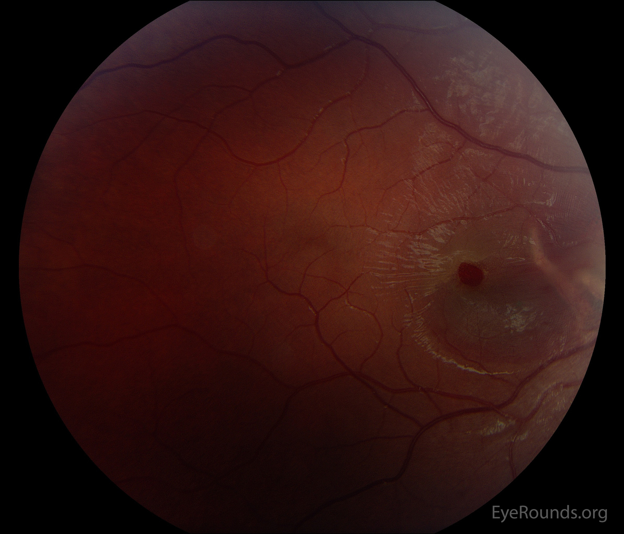 Choroidal rupture. EyeRounds.org: Online Ophthalmic Atlas