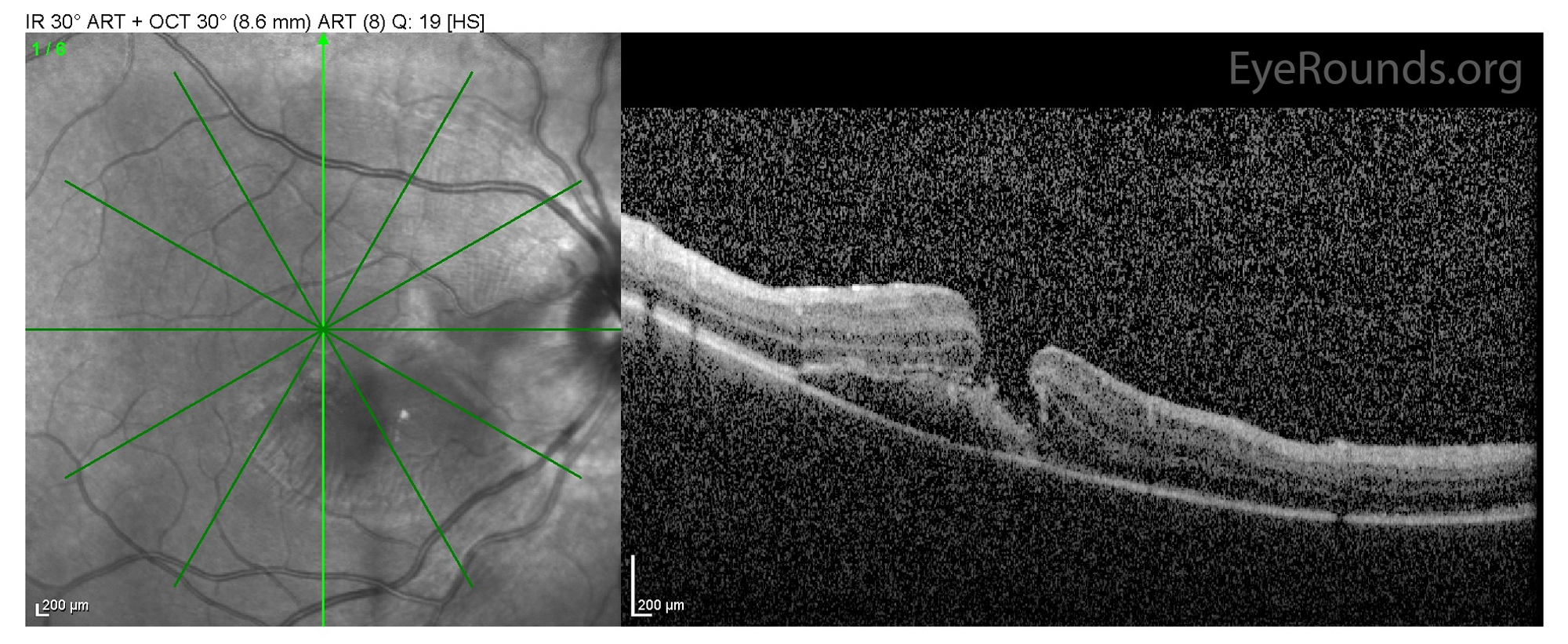 Choroidal rupture. EyeRounds.org: Online Ophthalmic Atlas