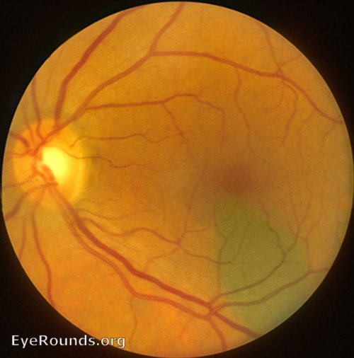 Choroidal nevus. EyeRounds.org: Online Ophthalmic Atlas