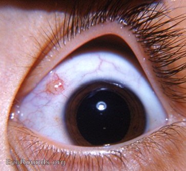 bulbar conjunctival lymph cyst. EyeRounds.org: Online Ophthalmic Atlas