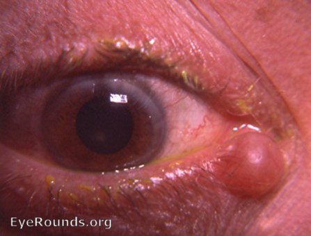 Cyst: cyst of gland of Moll; also, papilloma upper lid. EyeRounds.org ...